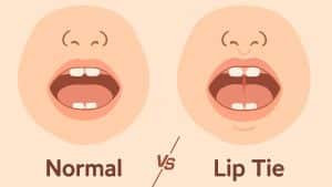 Lip Tie vs Normal: What Parents Need to Know - Mothers Always Right